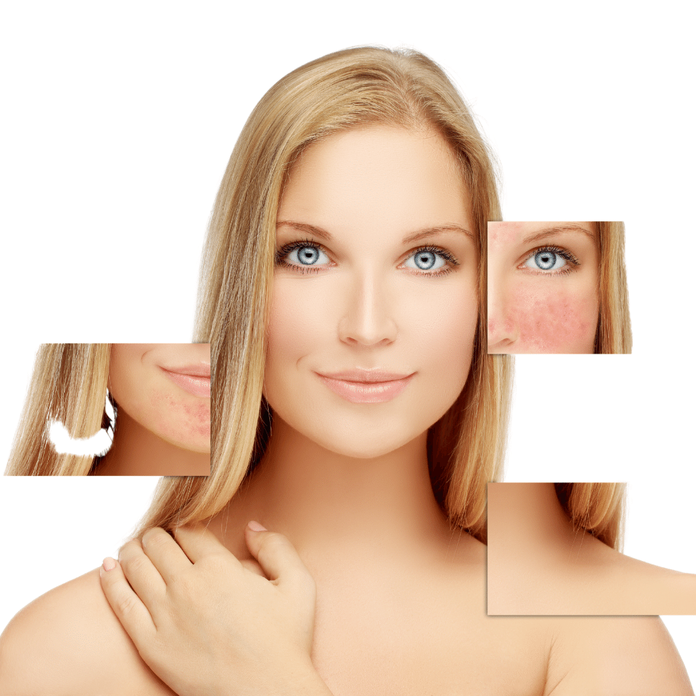 Rosacea – Beautify Your Skin